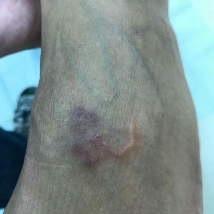 Pernah Temukan Luka Seperti Ini? Tanda Ada Cacing Parasit di Kulit