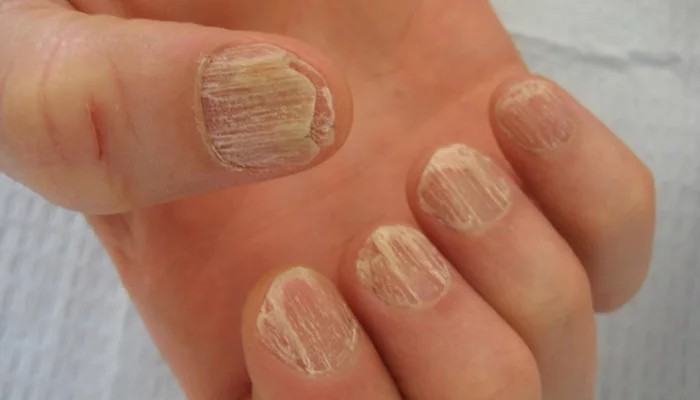 9 Contoh Tanda Penyakit yang Bisa Muncul di Kuku