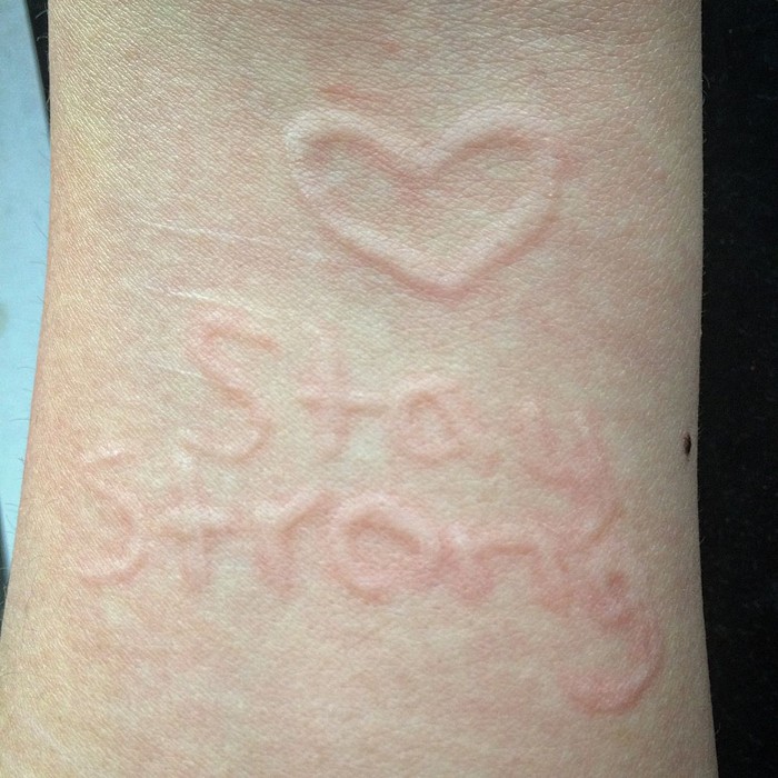 Dermatographia, Kondisi yang Bisa Bikin Tulisan Timbul di Permukaan Kulit