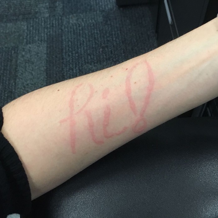 Dermatographia, Kondisi yang Bisa Bikin Tulisan Timbul di Permukaan Kulit