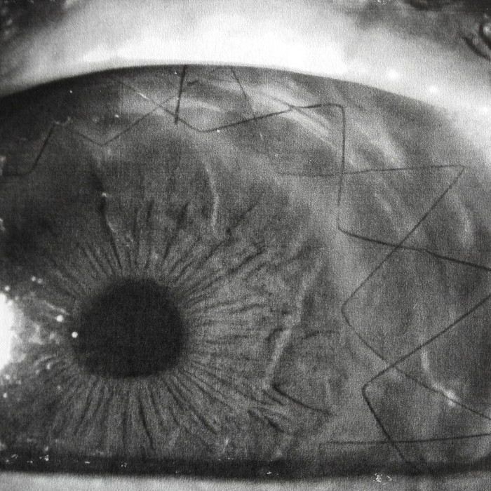 Bikin Ngilu atau Kagum? Begini Potret Jahitan Pada Kornea Mata