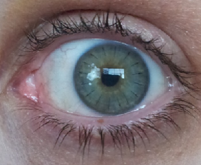 Bikin Ngilu atau Kagum? Begini Potret Jahitan Pada Kornea Mata