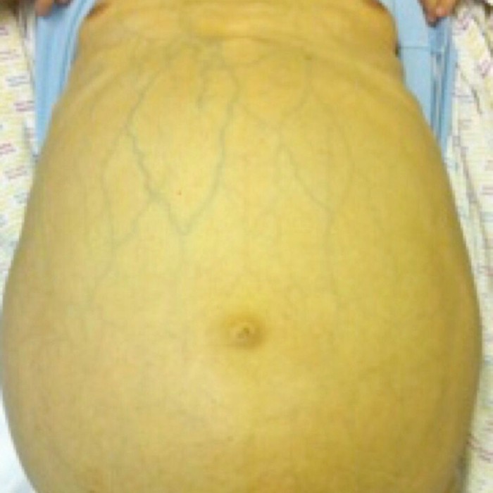 5 Gejala Hepatitis dalam Gambar