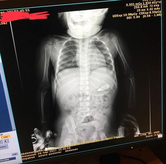 10 Foto yang Pernah Tertangkap X-Ray dari Tubuh Manusia, Bikin Merinding!