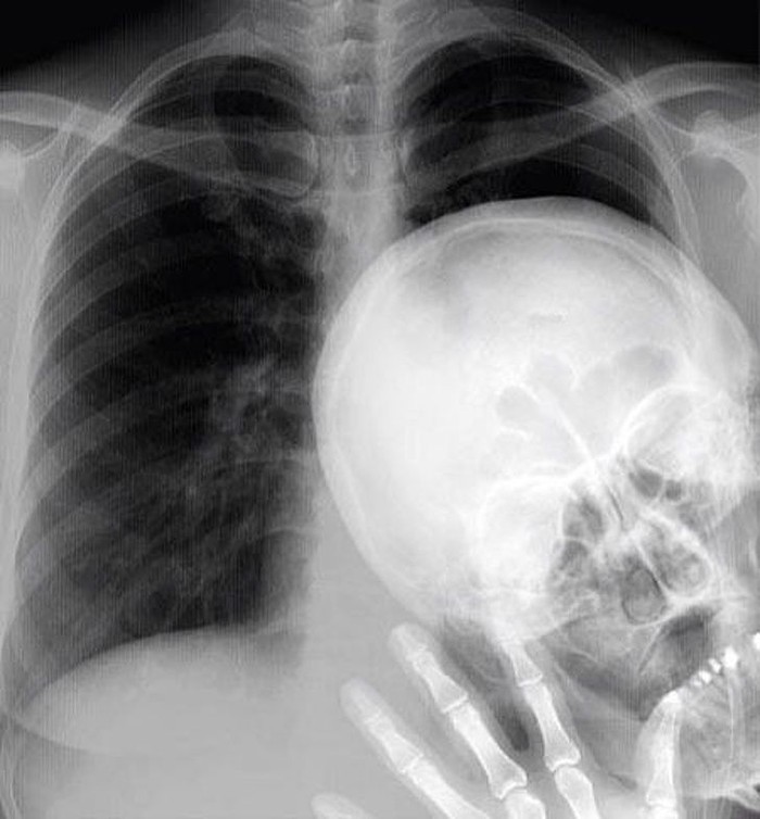 10 Foto yang Pernah Tertangkap X-Ray dari Tubuh Manusia, Bikin Merinding!