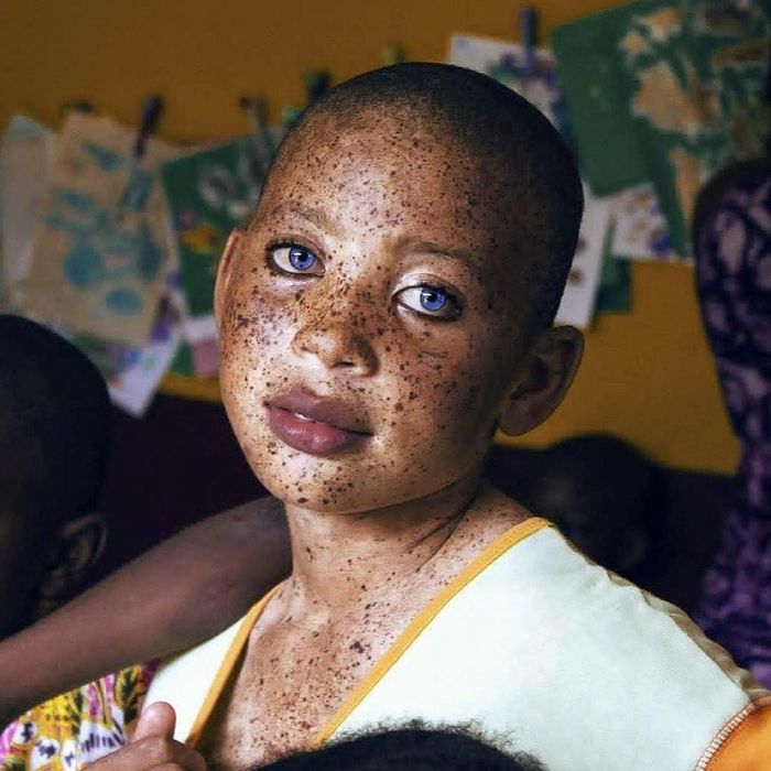 Mereka Bermata Biru Indah Karena Sindrom Waardenburg Foto 2