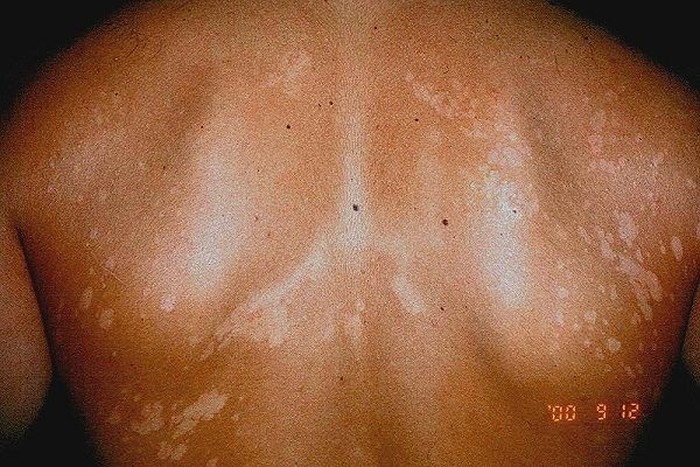 7 Macam Bercak Putih di Kulit yang Ternyata Panu