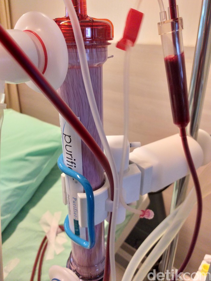 Mengenal Alat Cuci Darah yang 'Selangnya' Sempat Jadi Heboh