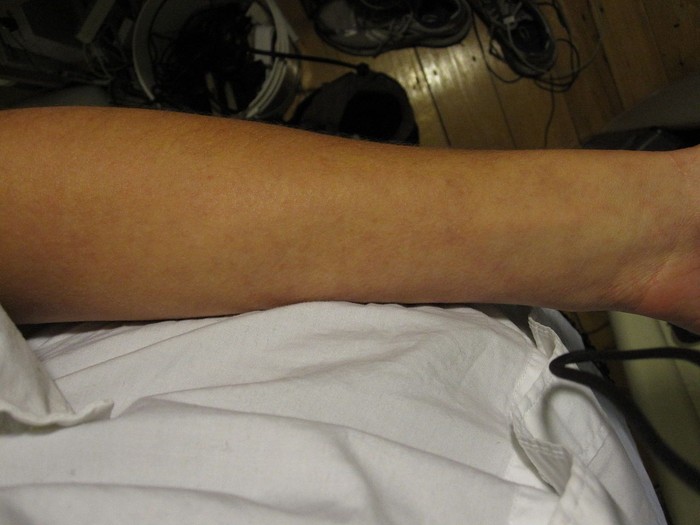 Waspada DBD, Begini Potret Ruam Merah Gejala Khas Penyakit