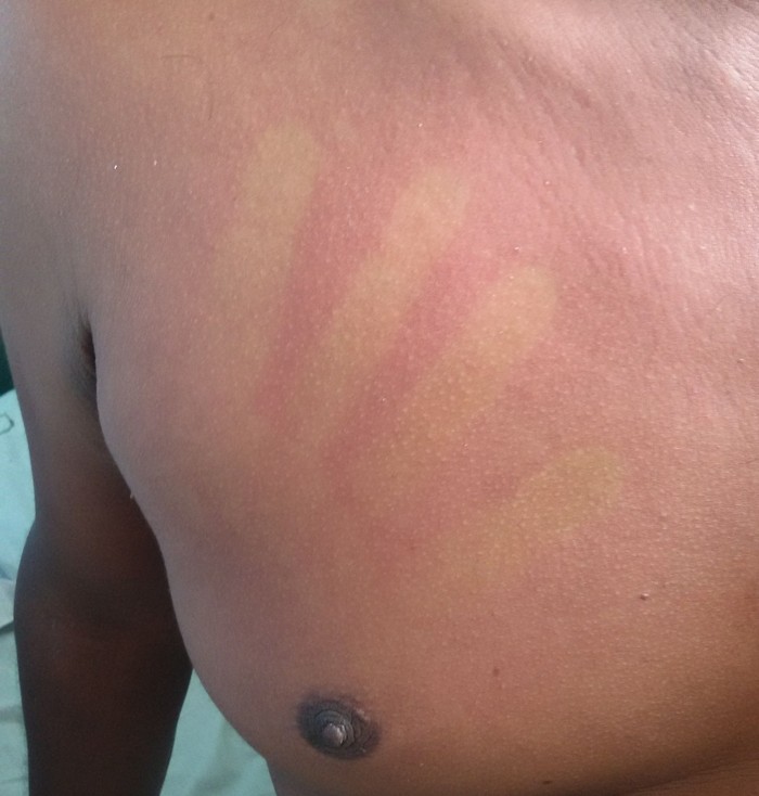 Waspada DBD, Begini Potret Ruam Merah Gejala Khas Penyakit