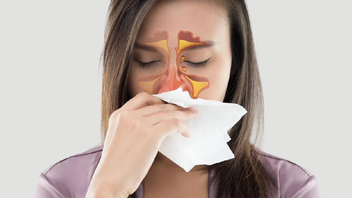 Sinusitis Adalah: Penyebab, Gejala, Pengobatan, dan Cara Pencegahannya
