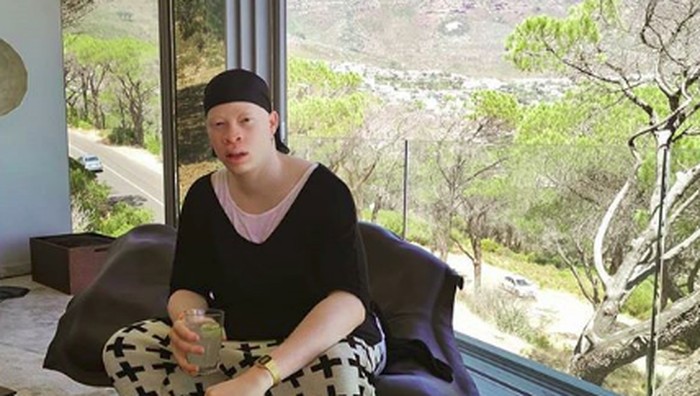 Potret Liburannya Model Albino, Sanele Junior Xaba
