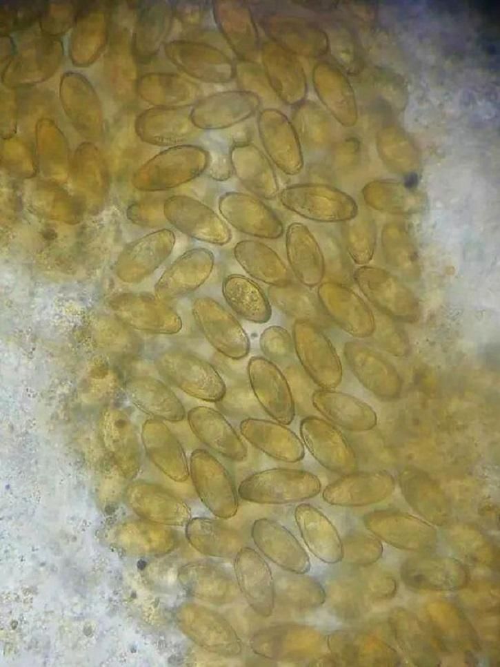 Waduh! Makan Ikan Mentah, Hati Pria Ini Digerogoti Cacing Waduh! Makan Ikan Mentah, Hati Pria Ini Digerogoti Cacing