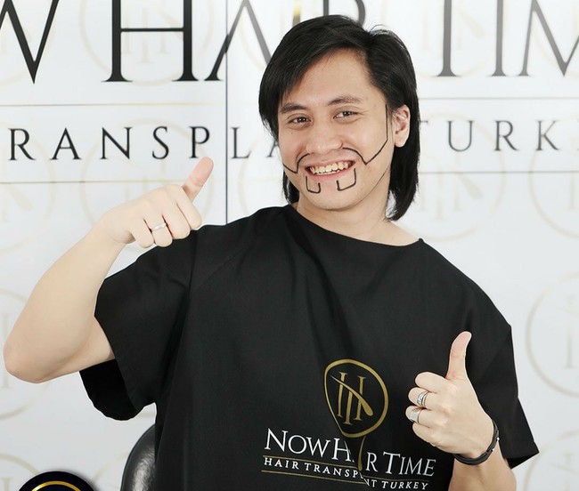 7 Foto Kevin Aprilio Cangkok Rambut di Turki, Sempat Tampil Botak