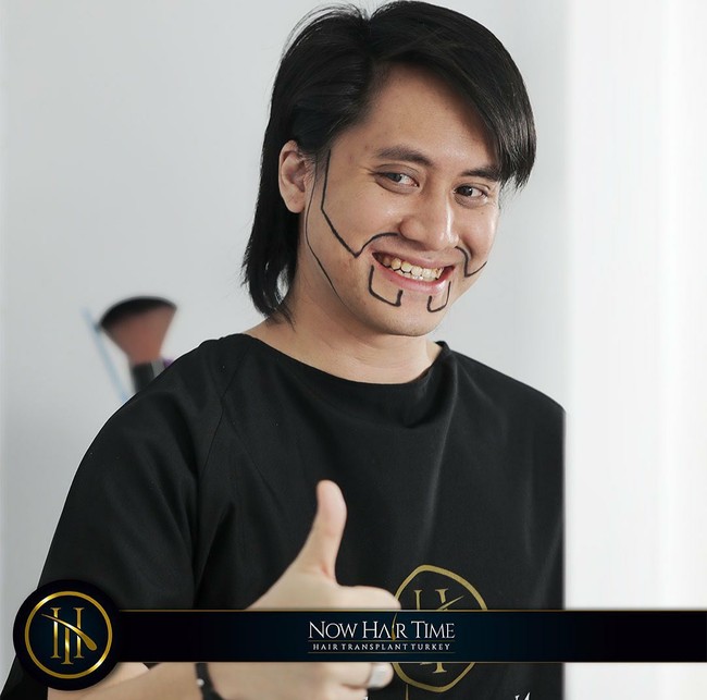 7 Foto Kevin Aprilio Cangkok Rambut di Turki, Sempat Tampil Botak