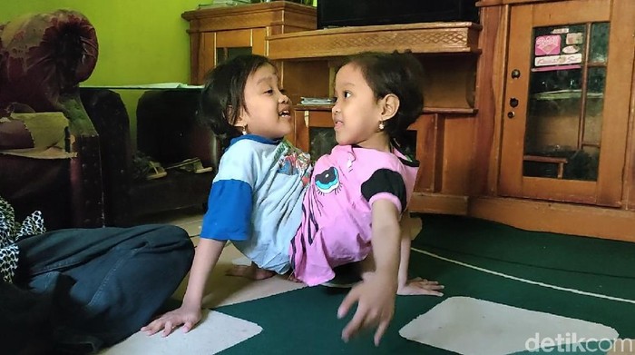 Potret Dewi dan Putri, Bocah Kembar Siam Dempet Perut di Garut