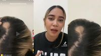 Viral Wanita Jakarta Curhat Mendadak Pitak, Ternyata Kena Penyakit Ini
