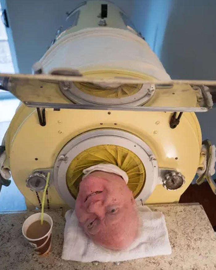 Potret Manusia Terakhir yang Hidup dalam Paru-paru Besi Gegara Polio