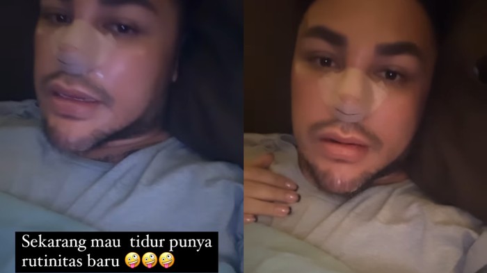 6 Potret Penampilan Hidung Baru Ivan Gunawan Pasca Operasi di Turki