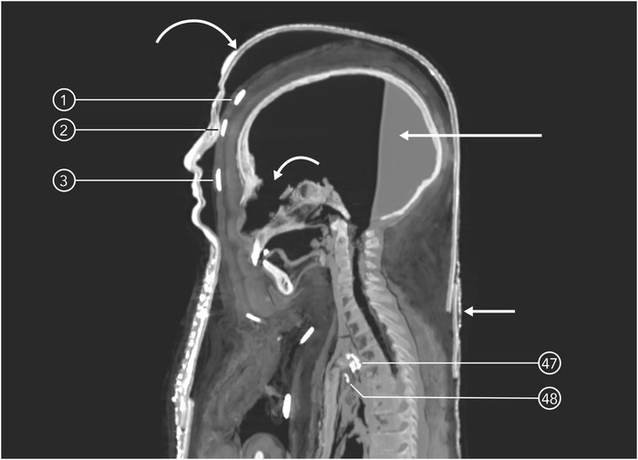 Potret Mumi Remaja dengan 49 Jimat Via Teknologi CT-scan