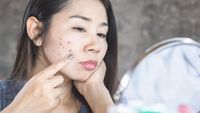 Dark Spot Adalah Bercak Gelap pada Kulit, Begini Cara Menghilangkannya!