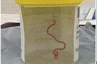 Dunia Hari Ini: Pasien Pertama di Dunia dengan Cacing Ditemukan di Otaknya