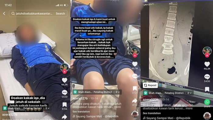 Kondisi Bocah Kena Prank Tarik Kursi, Memar hingga Patah Tulang Ekor Parah