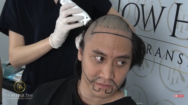 Foto 10 Artis Ini Transplantasi Rambut, Atta Halilintar Tanam Rambut di ...