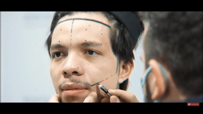 Foto 10 Artis Ini Transplantasi Rambut, Atta Halilintar Tanam Rambut di ...