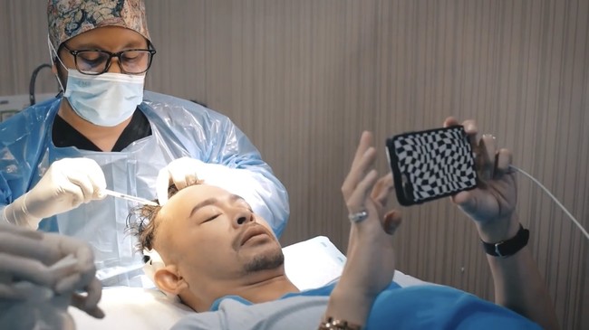 Foto 10 Artis Ini Transplantasi Rambut, Atta Halilintar Tanam Rambut di ...