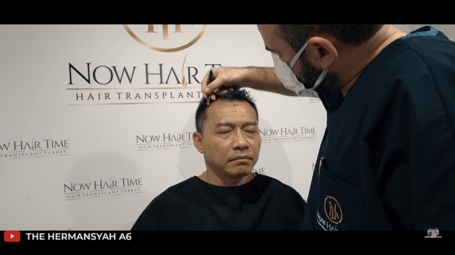 Foto 10 Artis Ini Transplantasi Rambut, Atta Halilintar Tanam Rambut di ...