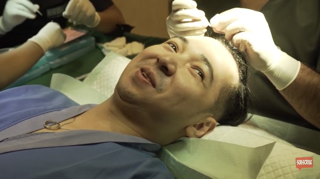 Foto 10 Artis Ini Transplantasi Rambut, Atta Halilintar Tanam Rambut di ...