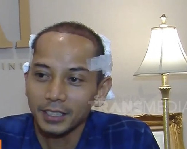 Foto 10 Artis Ini Transplantasi Rambut, Atta Halilintar Tanam Rambut di ...