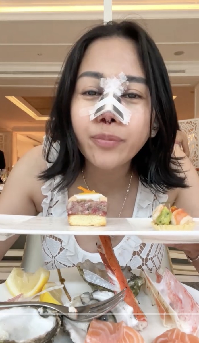 Farida Nurhan 'Omay' Brunch di Hotel Mewah dengan Kondisi Hidung Diperban