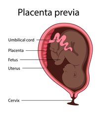 Plasenta Previa: Jenis, Penyebab, Gejala, dan Cara Mencegahnya