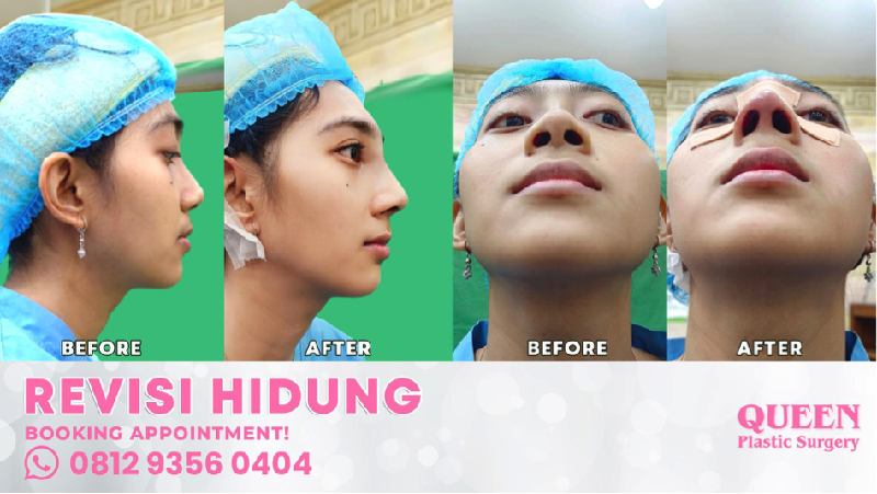 Ahli Revisi Hidung Terbaik Sejak 1993: Klinik Bedah Plastik Queen