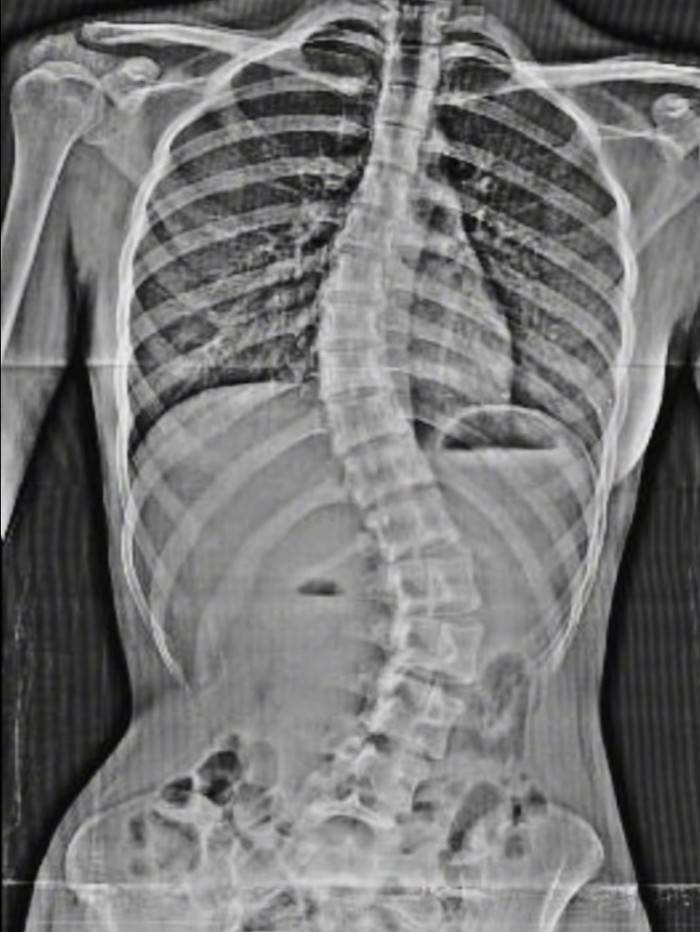 Nada Tarina Putri Alami Skoliosis hingga Setop Balet