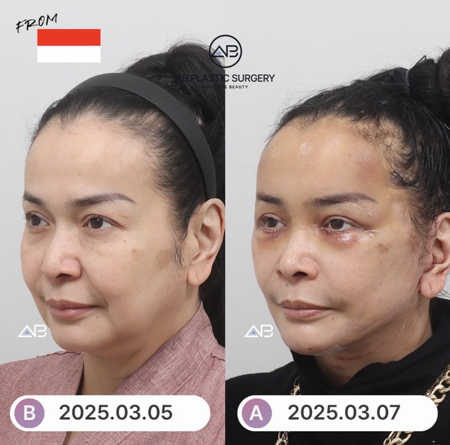 Foto Jennifer Jill-Ajun Perwira Oplas di Korea, Ini Hasilnya Setelah 8 ...