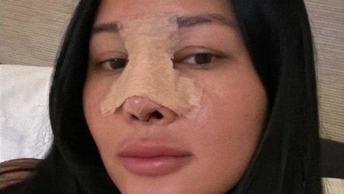 Mutia Ayu Operasi Hidung