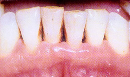 Abses Periodontal