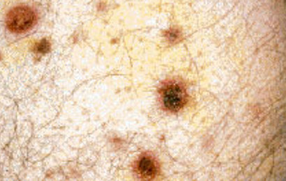 Behcet Syndrome