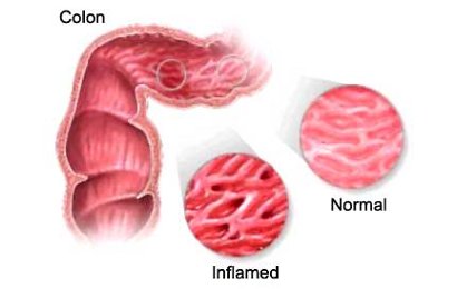 Ishemic Colitis