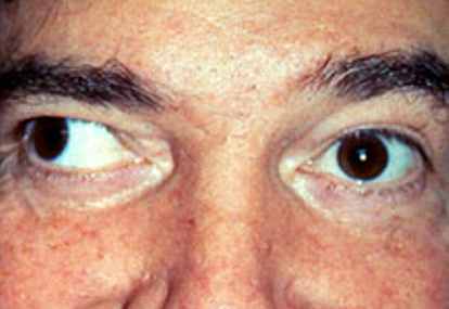 Penyebab Mata Juling