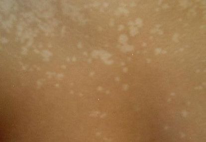 Panu yang Bikin Malu