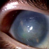 Tahi Lalat di Bola Mata, Jinak Tapi Bisa Berubah Ganas