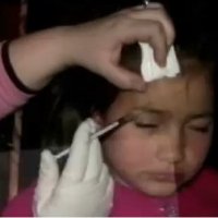 Gadis 8 Tahun yang Disuntik Botox Akhirnya Masuk Perawatan