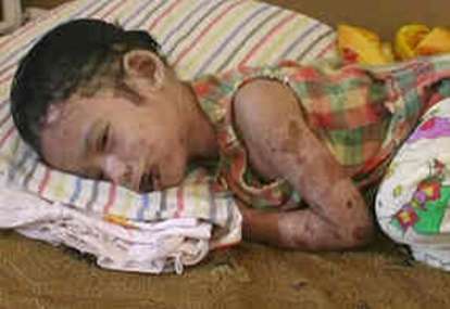 Stevens-Johnson Syndrome, Penyakit Alergi Obat yang Parah