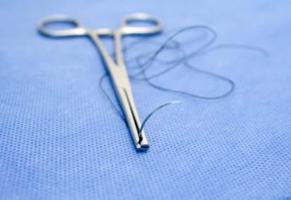 37 Tahun Hidup dengan Klem Bedah Tertinggal di Perut