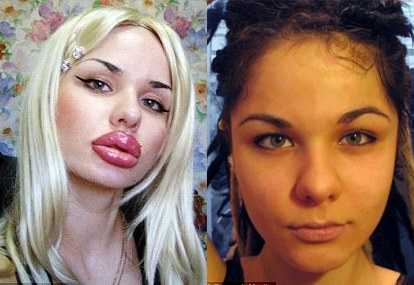 Bibir Dower Seperti Tokoh Kartun Setelah Disuntik 100 Kali