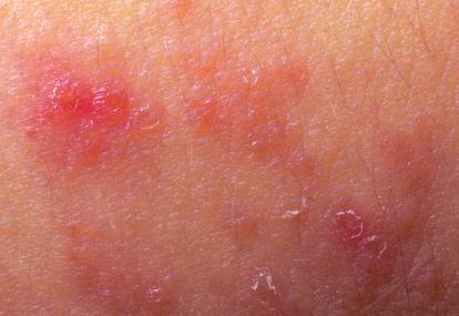 Tomcat Menyerang, Kulit Meradang